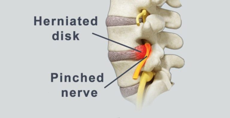 How to Get Rid of that Pinched Nerve in Your Hip - Clarendon Chiropractic