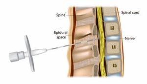 Back Pain after Your Epidural: Causes and Treatments of Vertebral ...