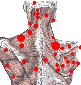 How to get rid of muscle knots? - Clarendon Chiropractic